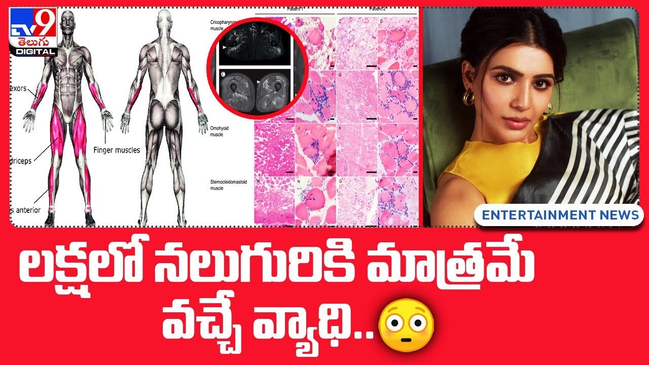 Samantha: లక్షలో నలుగురికి మాత్రమే వచ్చే వ్యాధి.. | Samantha Ruth ...